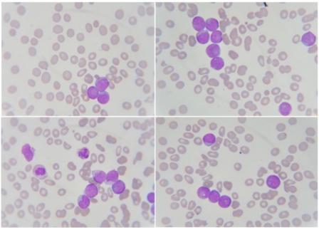 ADOPORT (tacrolimus) : nouveau médicament immunosupresseur indiqué dans ...