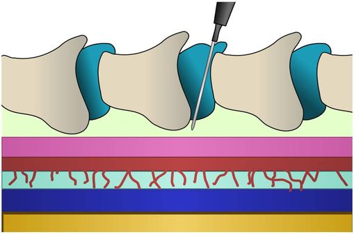 HYDROCORTANCYL (prednisolone) : restriction du périmètre de prise en ...