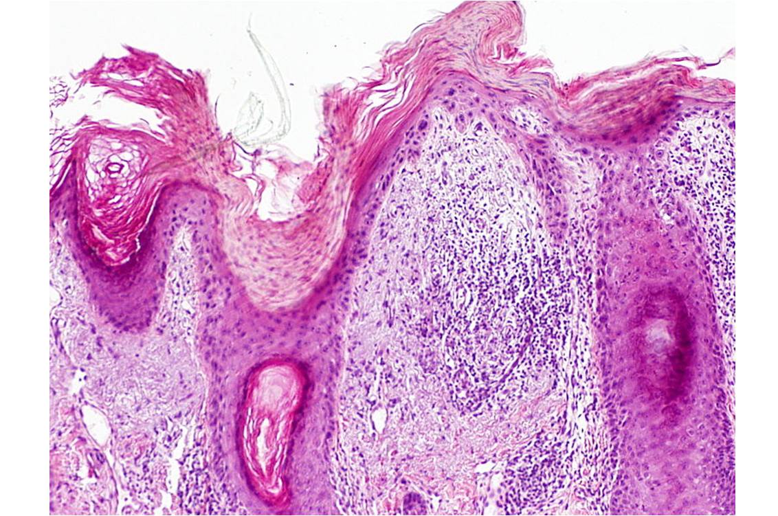 PICATO gel (mébutate d'ingénol) : nouveau médicament topique dans le ...