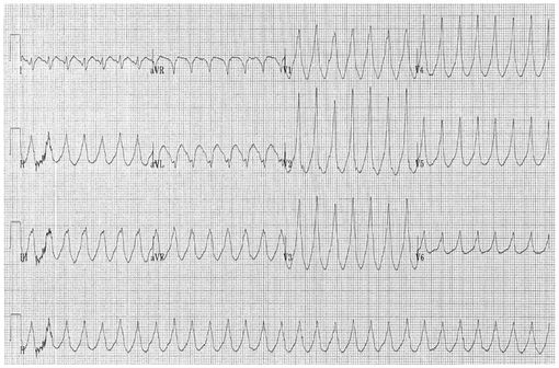 RYTHMOL (propafénone) : rupture d'approvisionnement